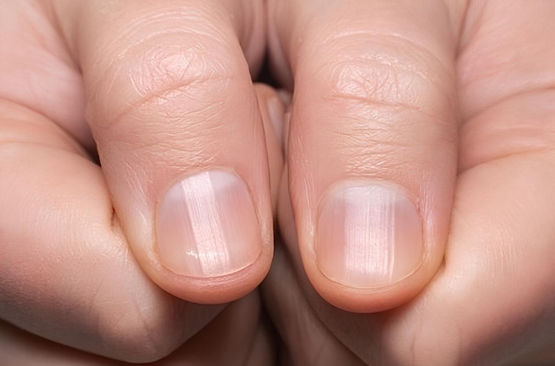 Móng tay bị gợn sóng: Cảnh báo sức khỏe tiềm ẩn và cách khắc phục hiệu quả